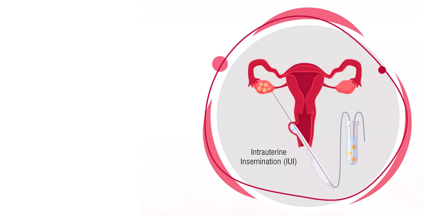 Iui Process Understanding Iui Procedure Step By Step Indira Ivf